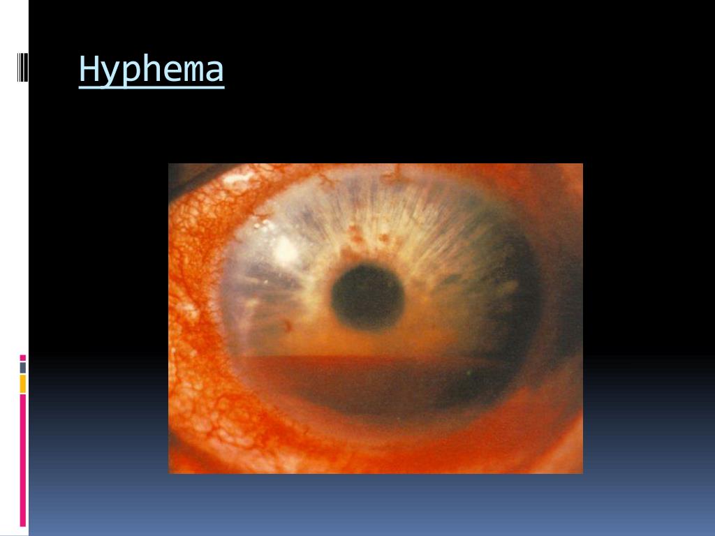 PPT - Secondary Open Angle & Angle Closure Glaucomas PowerPoint ... PPT - Secondary Open Angle & Angle Closure Glaucomas PowerPoint ...