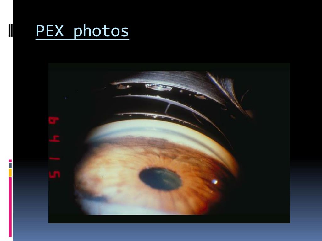 PPT - Secondary Open Angle & Angle Closure Glaucomas PowerPoint ... PPT - Secondary Open Angle & Angle Closure Glaucomas PowerPoint ...