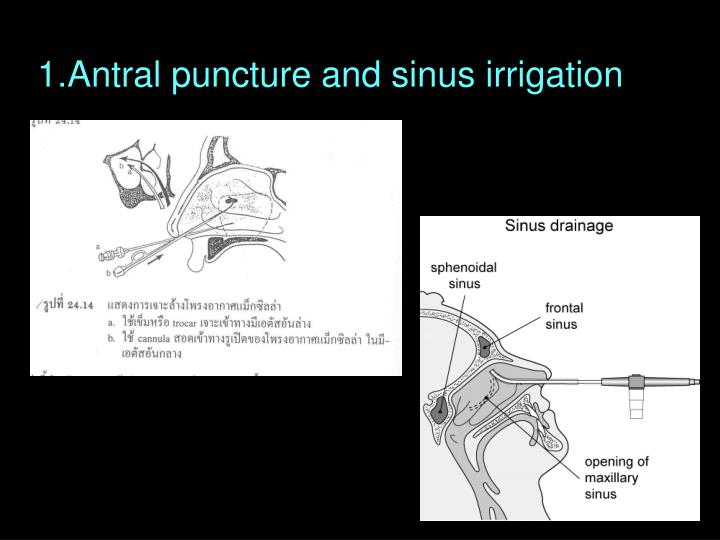 PPT - MAXILLARY PowerPoint Presentation - ID:3332920