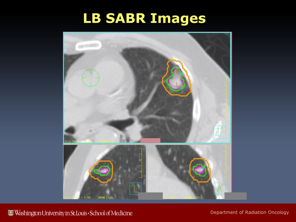 PPT - Jeffrey D. Bradley, M.D. S. Lee Kling Professor of Radiation ...