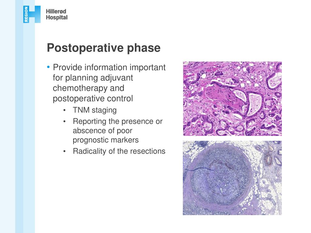 PPT - Colorectal cancer MDT Hillerød Hospital PowerPoint Presentation ...