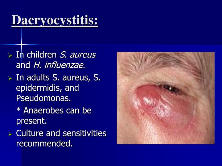 PPT - Posterior Blepharitis PowerPoint Presentation - ID:3336265