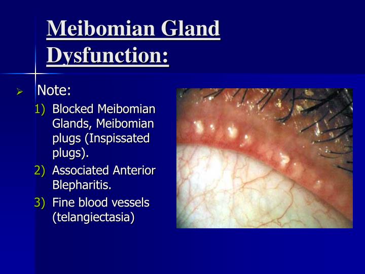 PPT - Posterior Blepharitis PowerPoint Presentation - ID:3336265