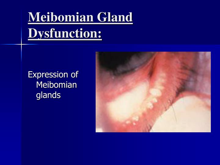 PPT - Posterior Blepharitis PowerPoint Presentation - ID:3336265
