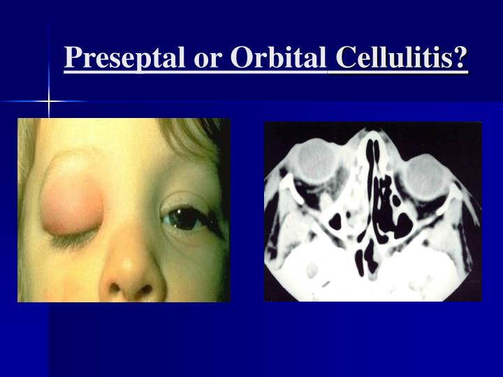 PPT - Posterior Blepharitis PowerPoint Presentation - ID:3336265