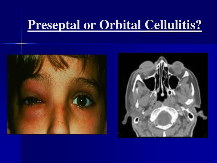 PPT - Posterior Blepharitis PowerPoint Presentation - ID:3336265