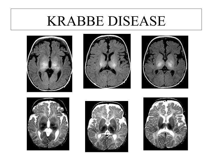 PPT - Leukodystrophy PowerPoint Presentation - ID:3337515