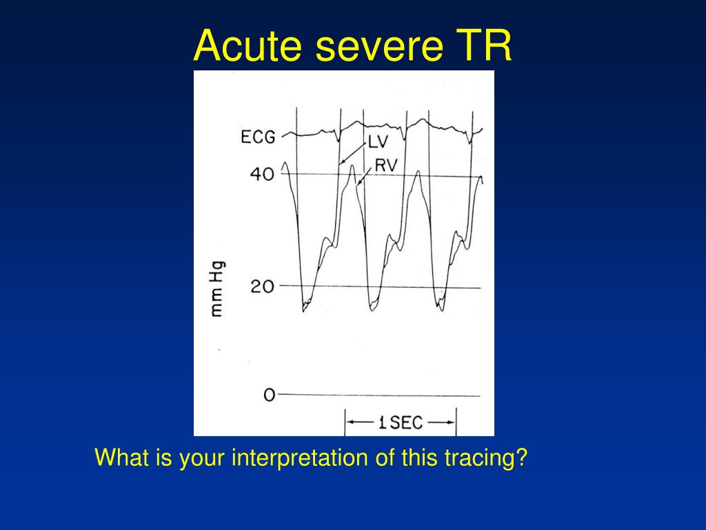 PPT - Cath-Lab Hemodynamics – I : Pressure tracings in the diseased ...