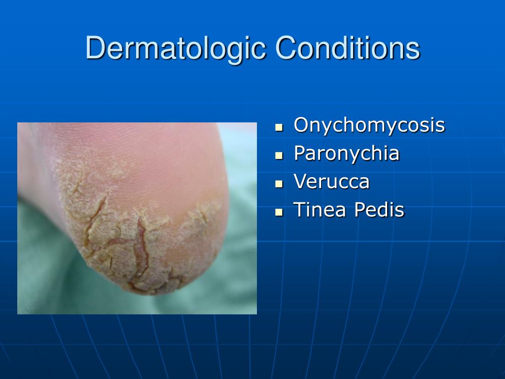PPT - Diagnosis and Treatment of Common Foot Conditions PowerPoint ...