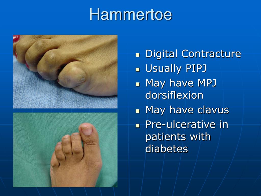PPT - Diagnosis and Treatment of Common Foot Conditions PowerPoint ...