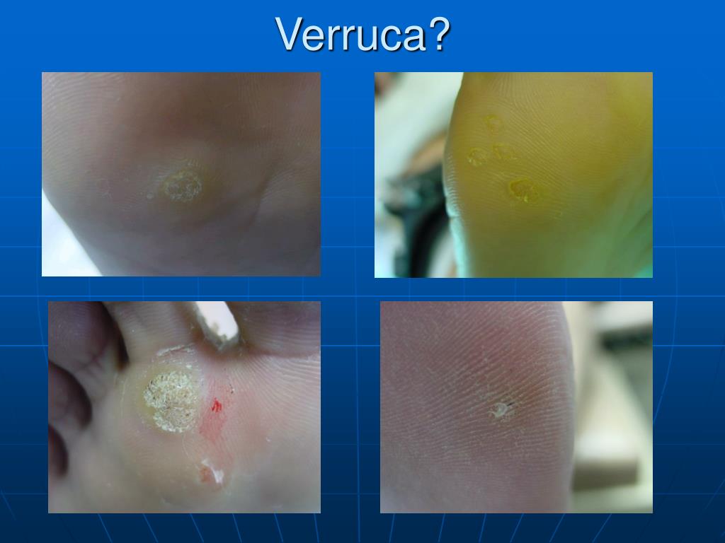 PPT - Diagnosis and Treatment of Common Foot Conditions PowerPoint ...