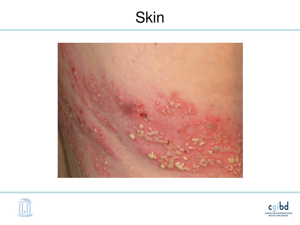 PPT - Prevention and treatment of opportunistic infections in IBD: Case ...