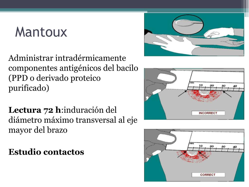 PPT - Hay tuberculosis en el colegio, ¿Qué hago? PowerPoint ...