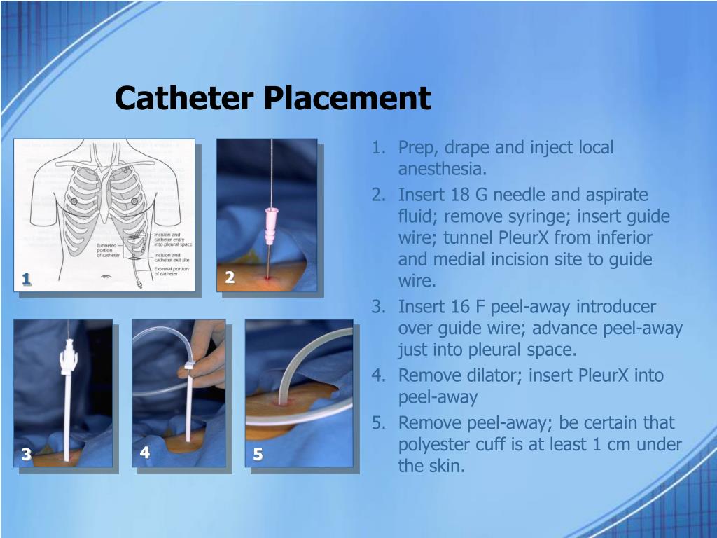PPT - Malignant Pleural Effusions: Treatment with Indwelling Pleural ...