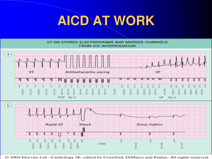 PPT - CARE OF PPI AND ICD IN THE CCU PowerPoint Presentation - ID:3341822