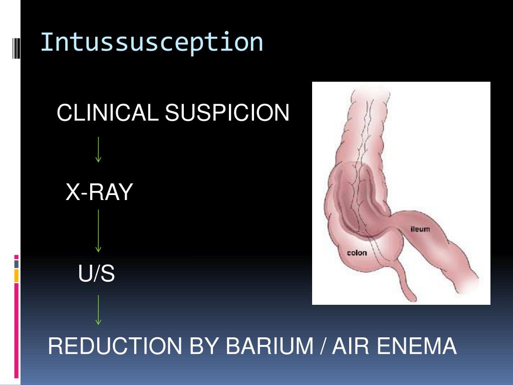 PPT - Pediatric non-traumatic Surgical Emergencies PowerPoint ...