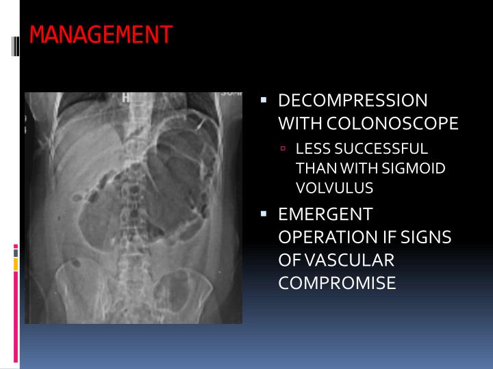 PPT - VOLVULUS PowerPoint Presentation - ID:3343529