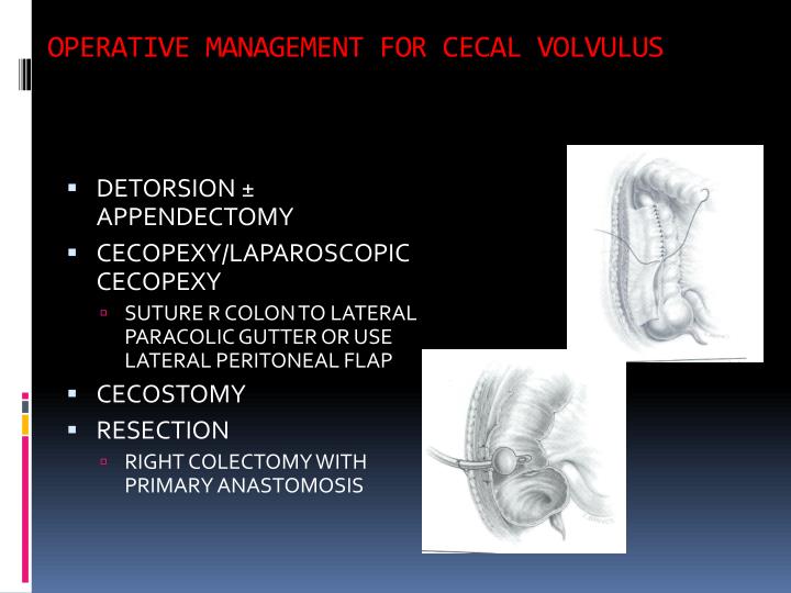 PPT - VOLVULUS PowerPoint Presentation - ID:3343529