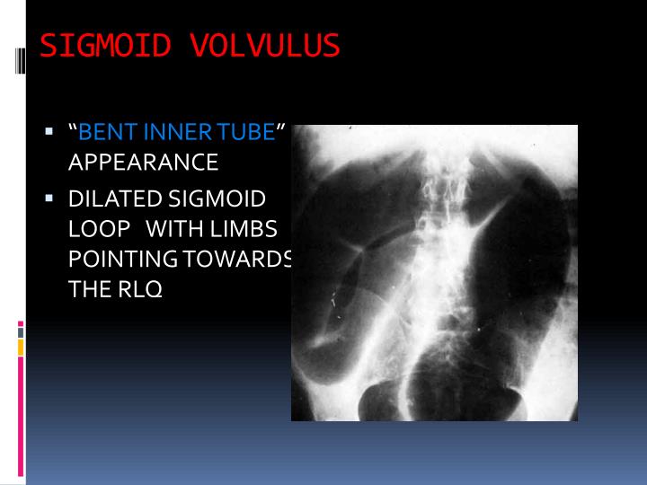 PPT - VOLVULUS PowerPoint Presentation - ID:3343529
