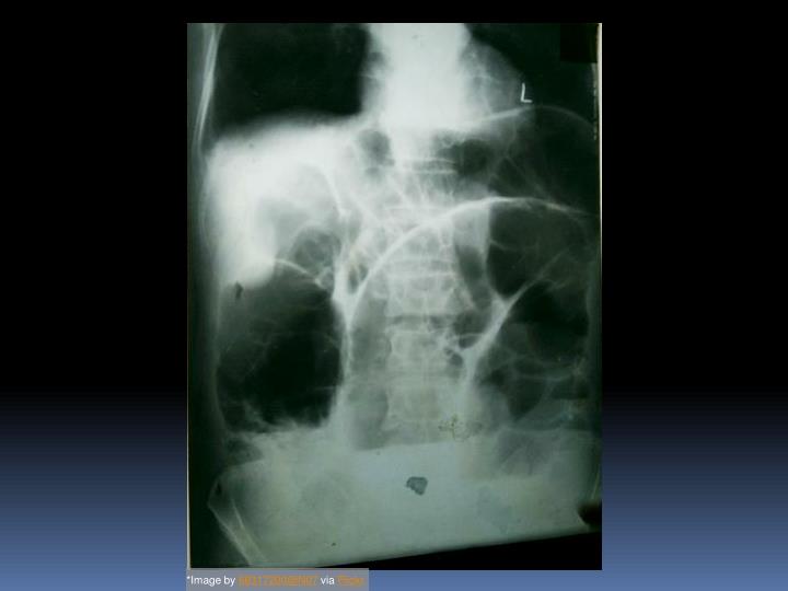 PPT - VOLVULUS PowerPoint Presentation - ID:3343529