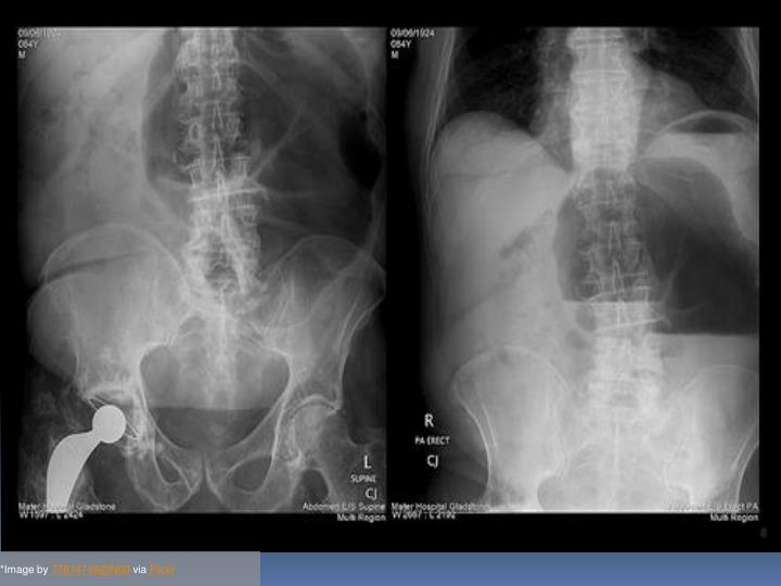 PPT - VOLVULUS PowerPoint Presentation - ID:3343529