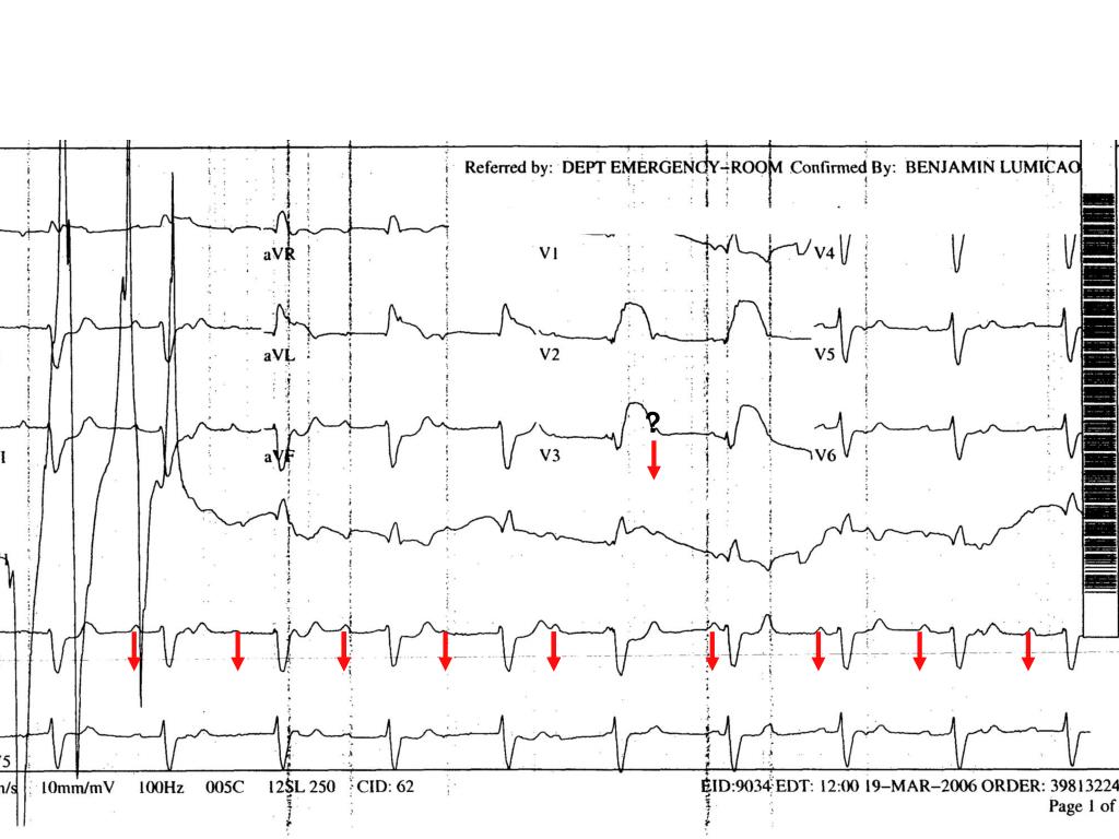 PPT - Cardiogenic Shock Diagnosis, Treatment and Guidelines PowerPoint ...