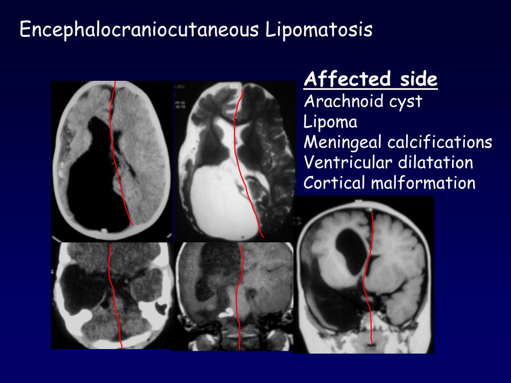 PPT - Phenotipic identification of neurological malformations ...