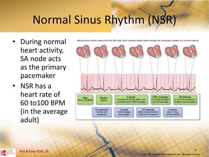 PPT - Sinus Dysrhythmias PowerPoint Presentation - ID:3345190
