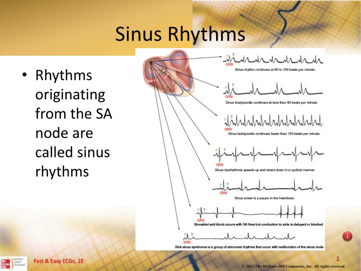 PPT - Sinus Dysrhythmias PowerPoint Presentation - ID:3345190