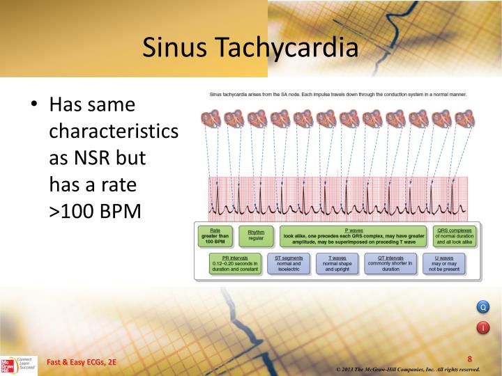 PPT - Sinus Dysrhythmias PowerPoint Presentation - ID:3345190