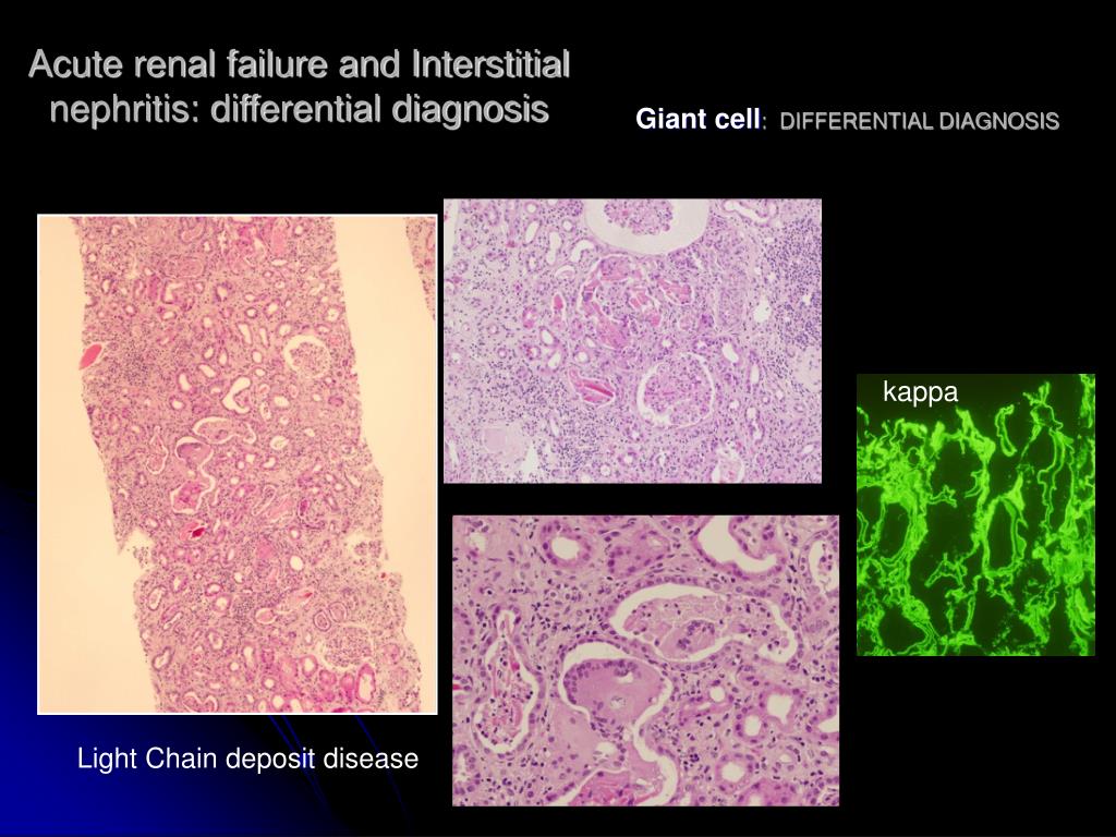 PPT - Nephropathology Slide seminar case 3. Granulomatous interstitial ...