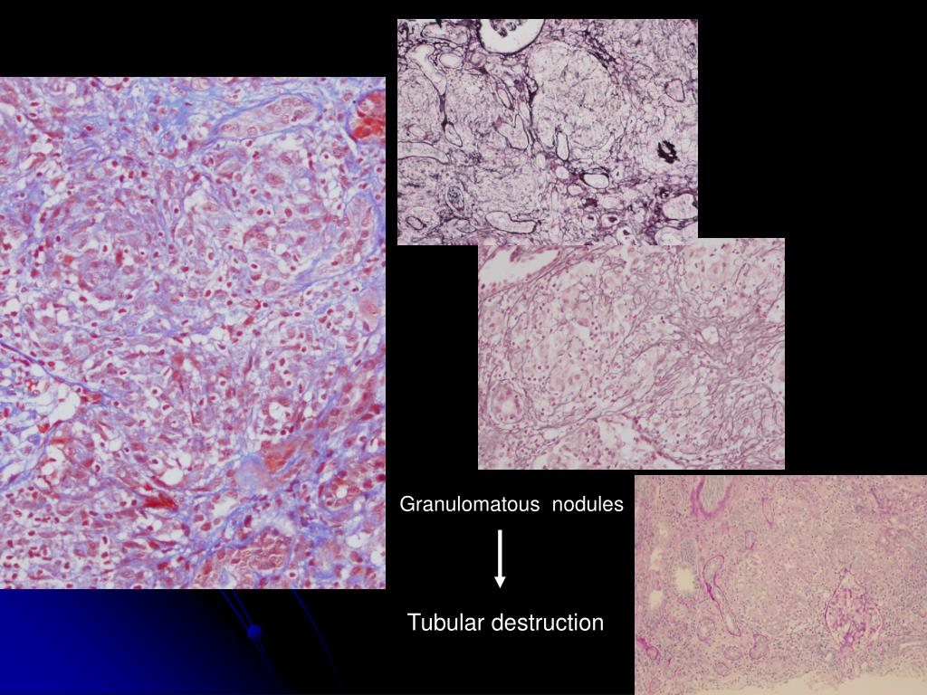 PPT - Nephropathology Slide seminar case 3. Granulomatous interstitial ...