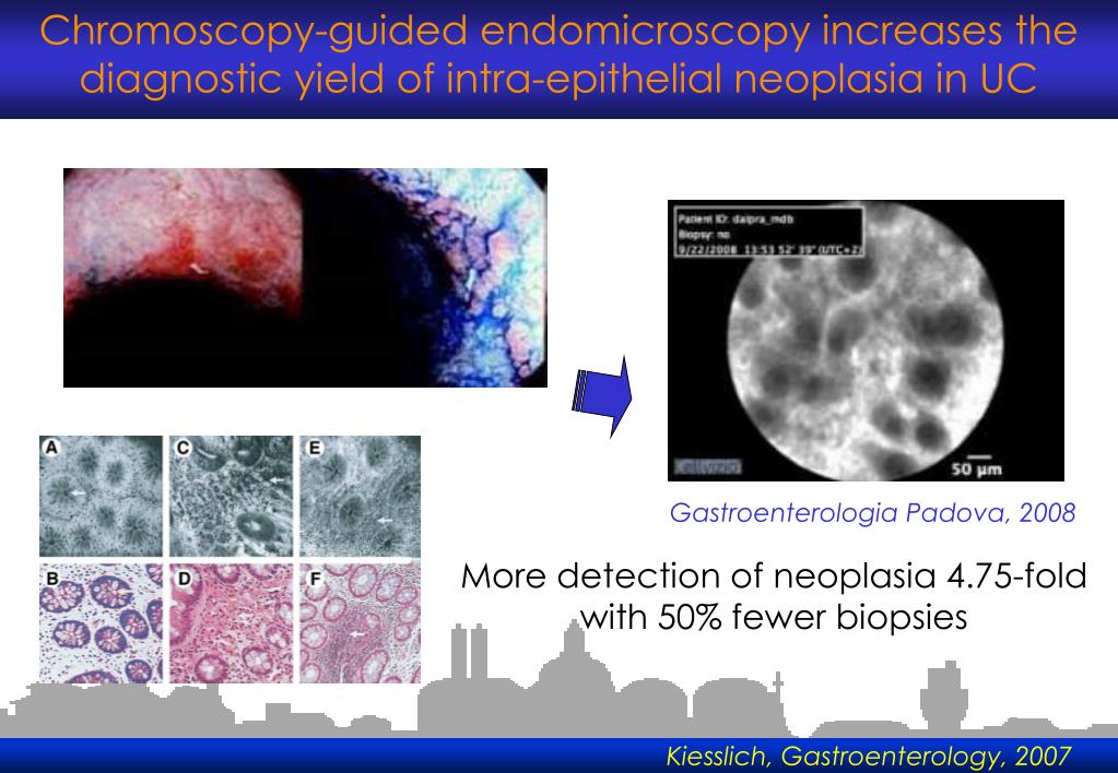 PPT - Di fronte alla displasia intestinale Colon e Retto PowerPoint ...