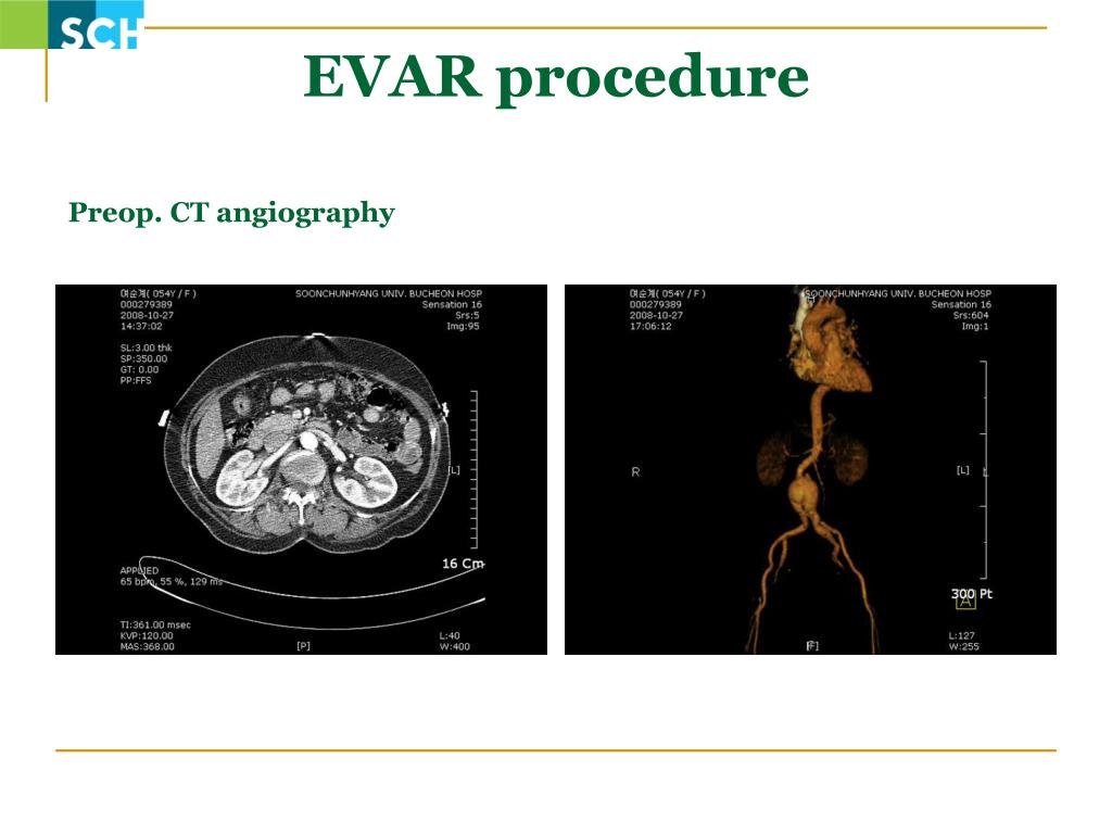 PPT - Abdominal Aortic Aneurysm and Peripheral Disease PowerPoint ...