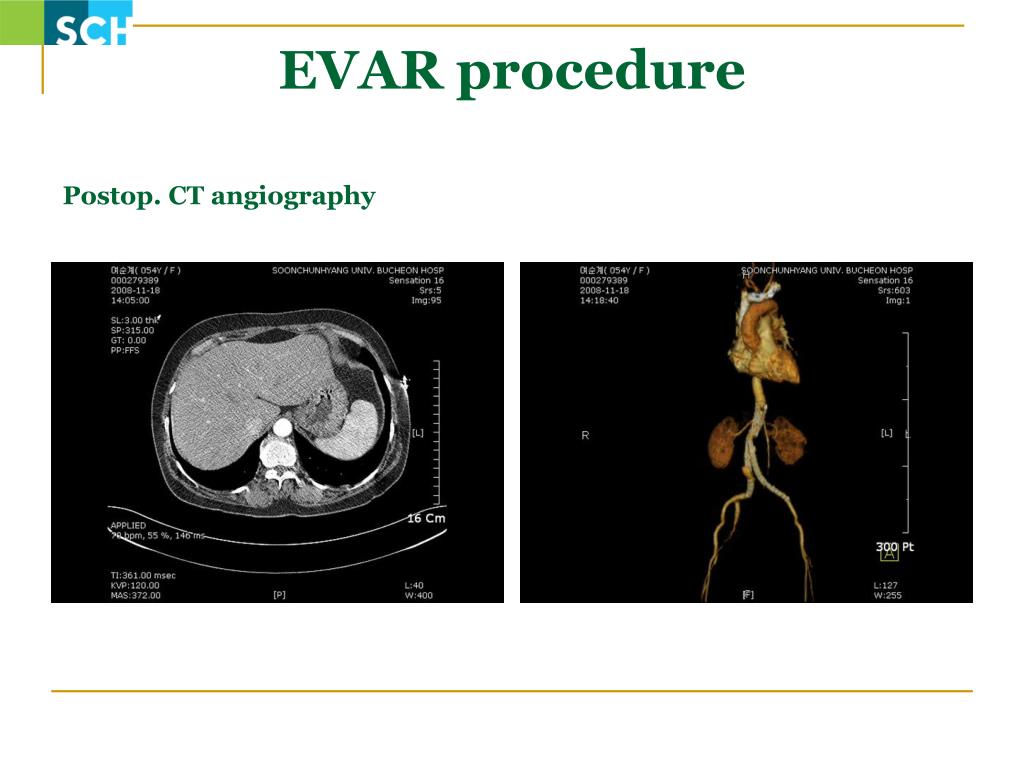 PPT - Abdominal Aortic Aneurysm and Peripheral Disease PowerPoint ...