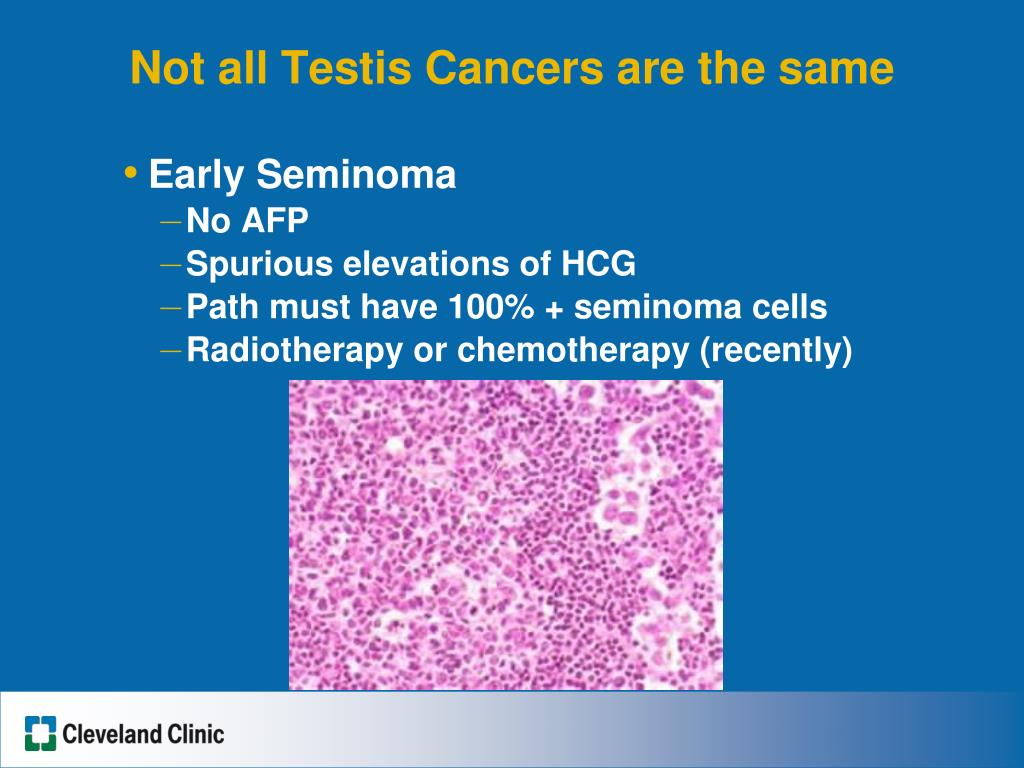 PPT - Understanding Testicular Cancer: A MUST for the Medical ...