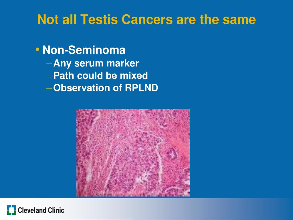 PPT - Understanding Testicular Cancer: A MUST for the Medical ...