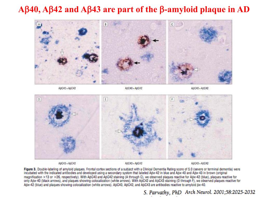 PPT - Alois Alzheimer (1864-1915) PowerPoint Presentation, free ...