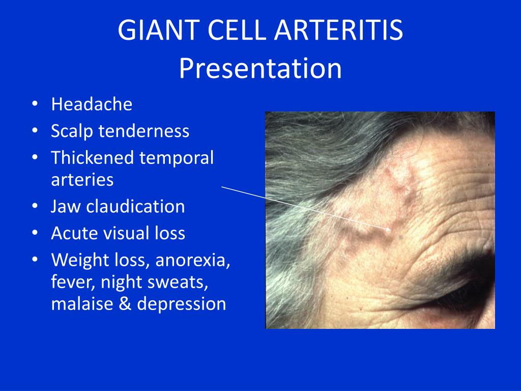 PPT Polymyalgia Rheumatica And Giant Cell Arteritis PowerPoint