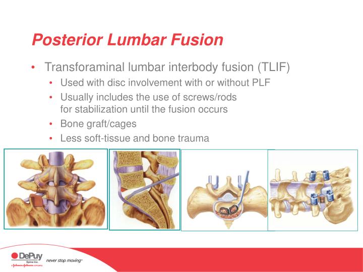 PPT - Lumbar Spine Pathologies and Treatments PowerPoint Presentation ...