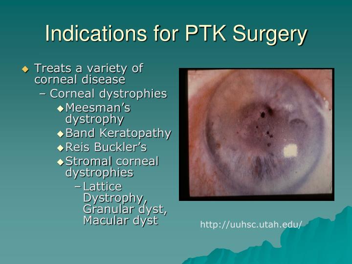 PPT - Phototherapeutic Keratectomy PowerPoint Presentation - ID:3356703