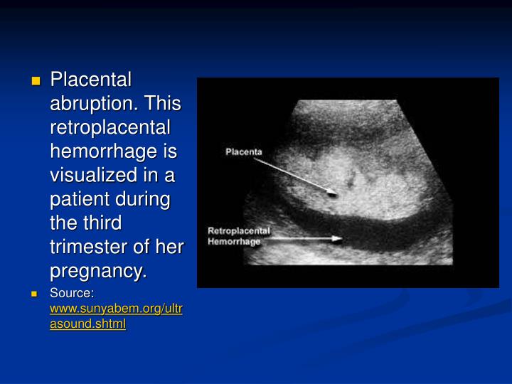 PPT - Placental US PowerPoint Presentation - ID:3356735