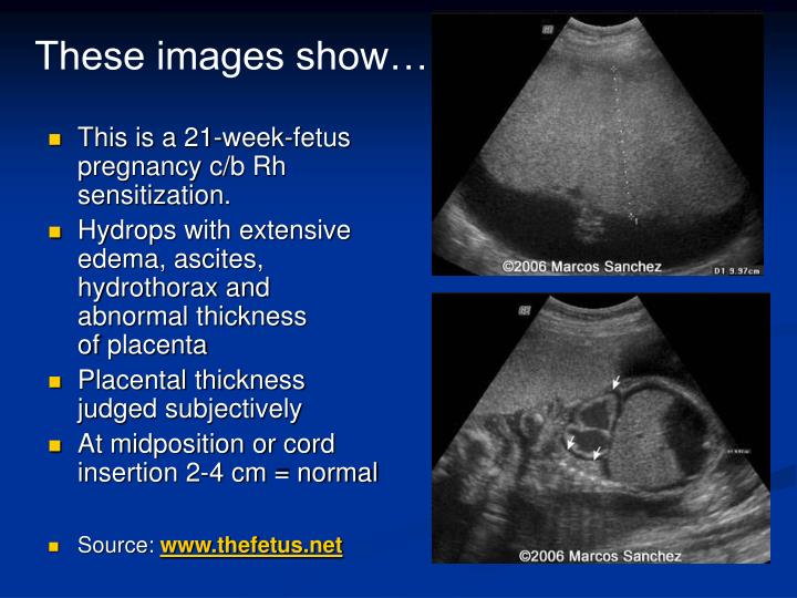 PPT - Placental US PowerPoint Presentation - ID:3356735