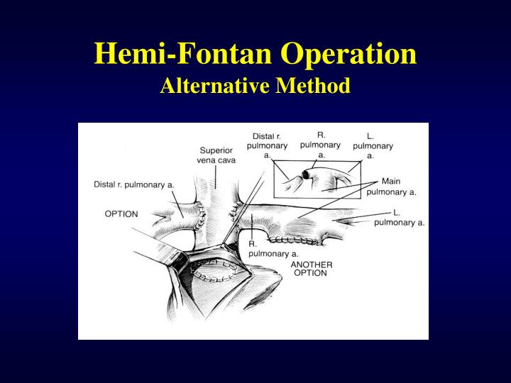 PPT - Bidirectional Cavo-pulmonary Anastomosis PowerPoint Presentation ...