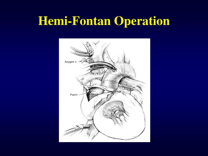 PPT - Bidirectional Cavo-pulmonary Anastomosis PowerPoint Presentation ...