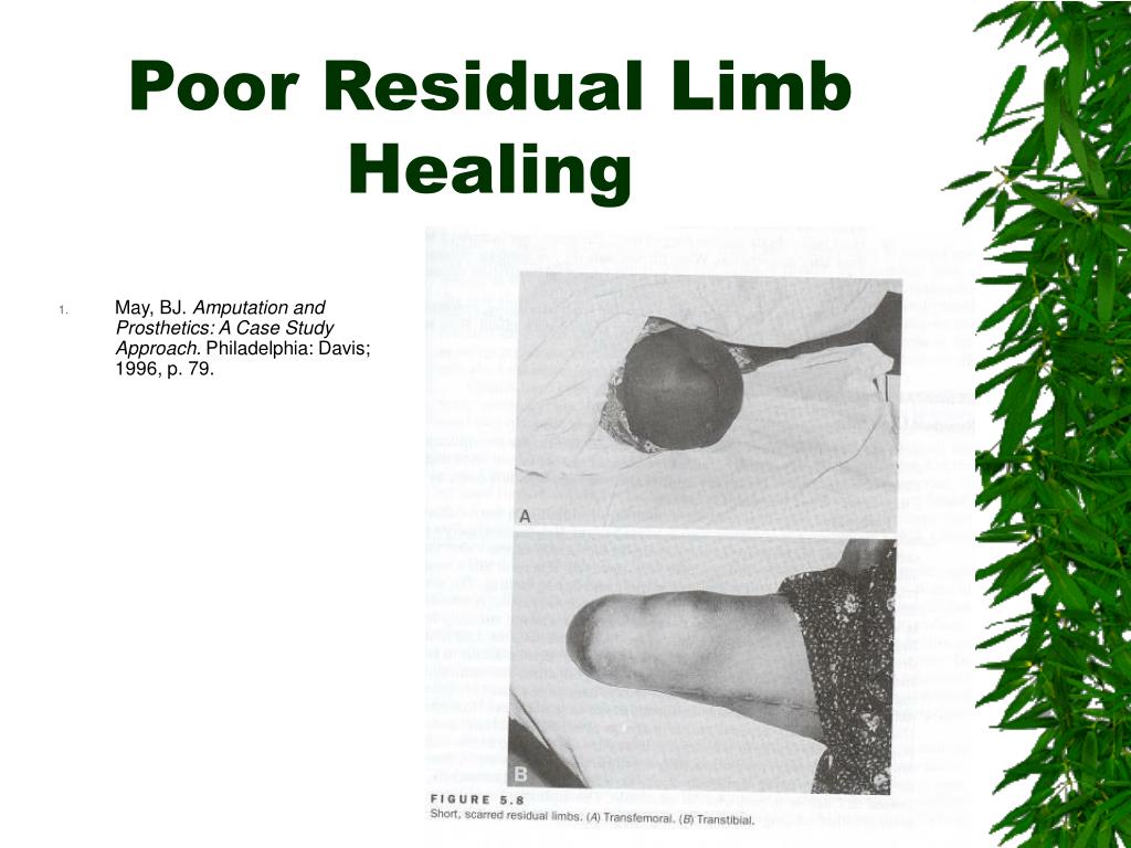 PPT - Examination & Treatment of the Lower Extremity Amputee PowerPoint ...