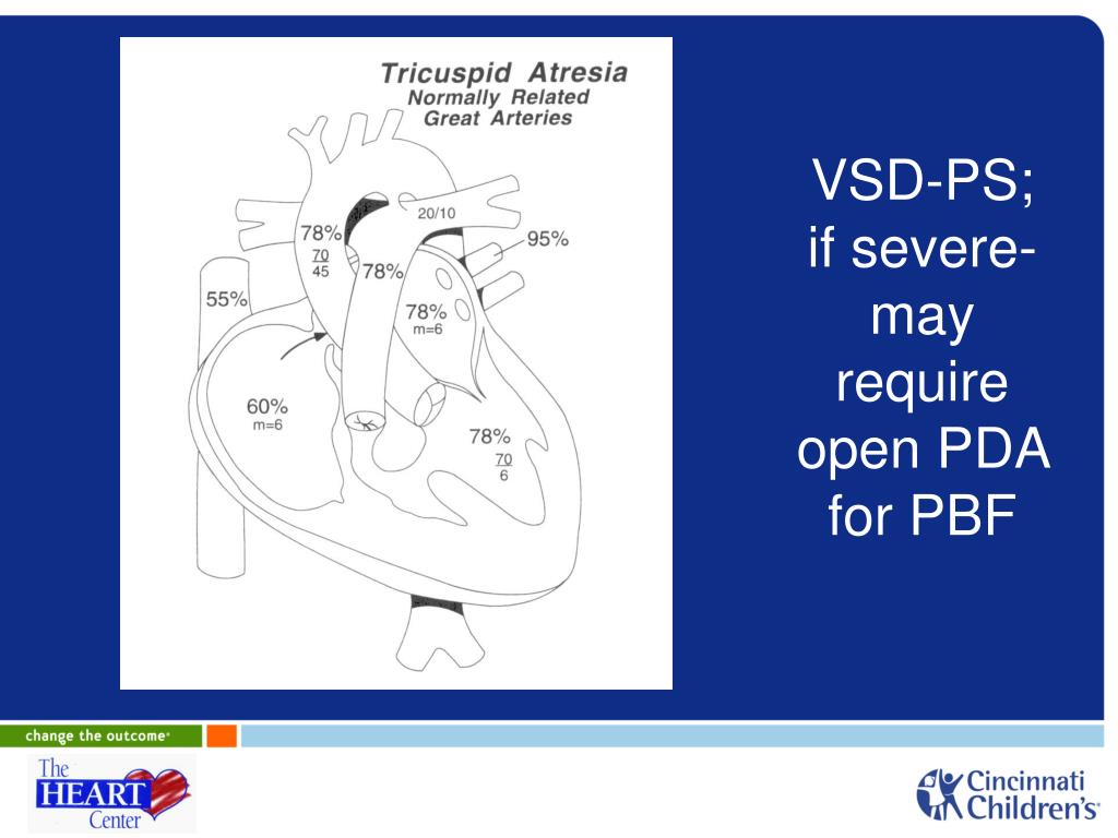 PPT - Critical Congenital Heart Disease in the Newborn: Anatomy ...