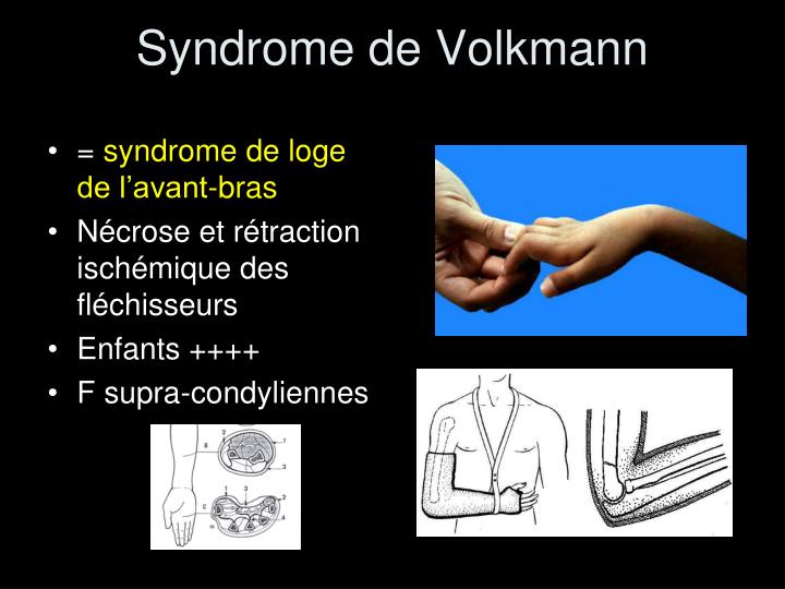 PPT - Surveillance d’un malade sous plâtre Indications – Modalités ...