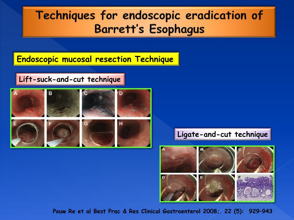 PPT Endoscopic Mucosal Resection Vs Radiofrequency Ablation In PPT Endoscopic Mucosal Resection Vs Radiofrequency Ablation In