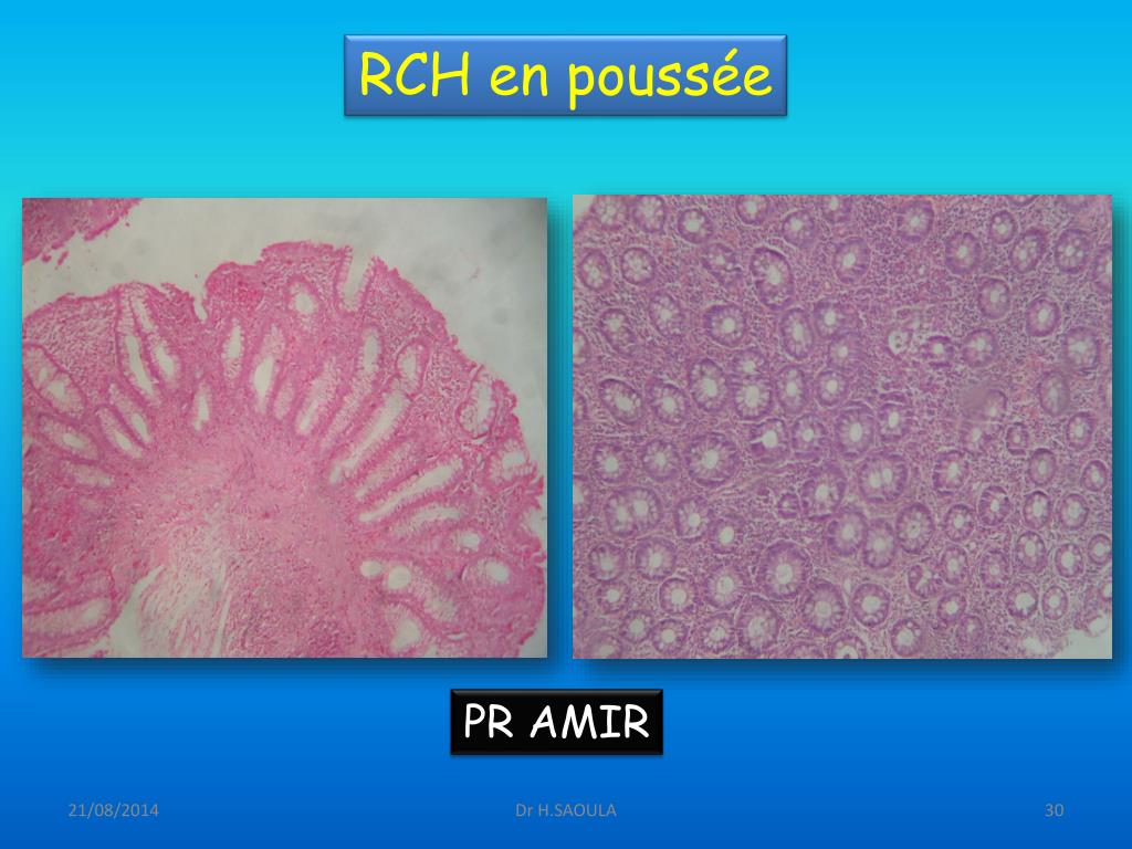 PPT - DEPISTAGE DU CANCER COLORECTAL DANS LA RECTOCOLITE HEMORRAGIQUE ...